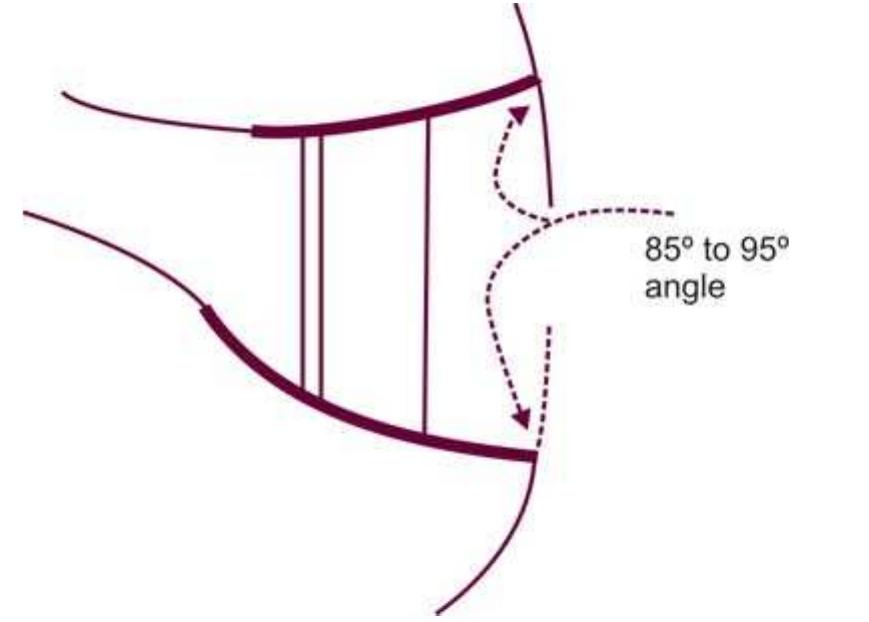 3: reverse curve in occlusal outline of proximal cavosurface