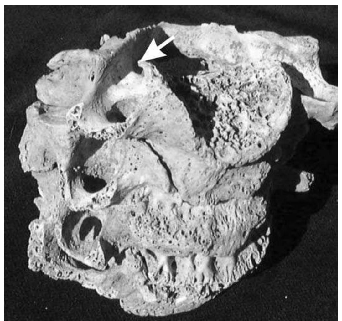 6. cervical vertebrae (c3—c5) with disc disease. note the
