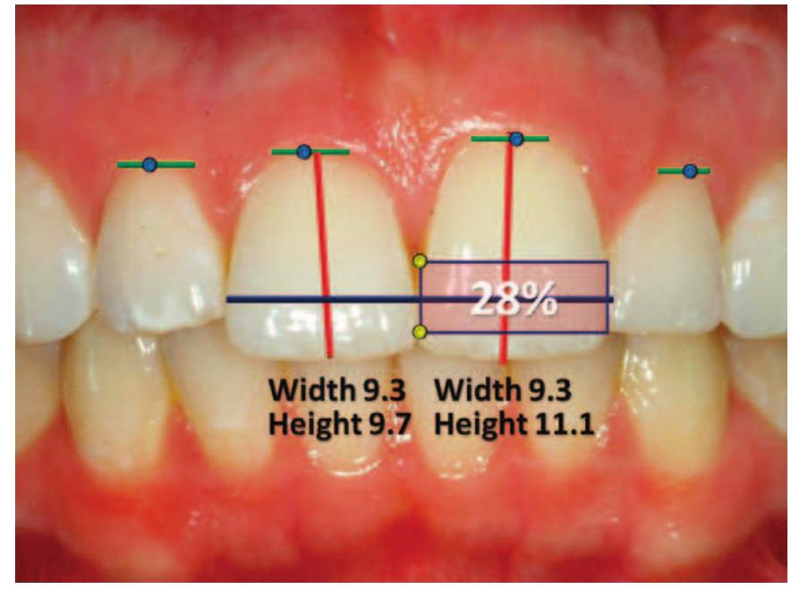 The microesthetic assessment of the anterior teeth
