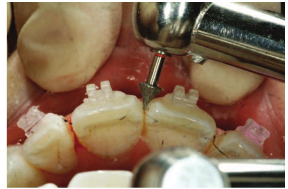 Ii. interproximal reshaping results in line angles that