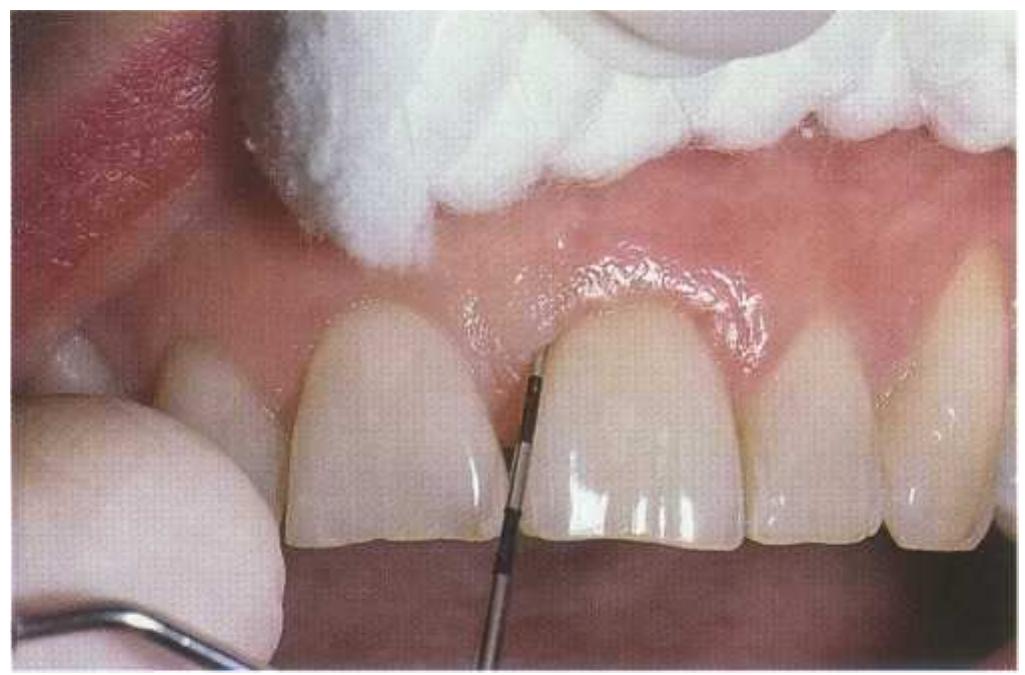 -14 a limited periodontal assessment can be obtained by