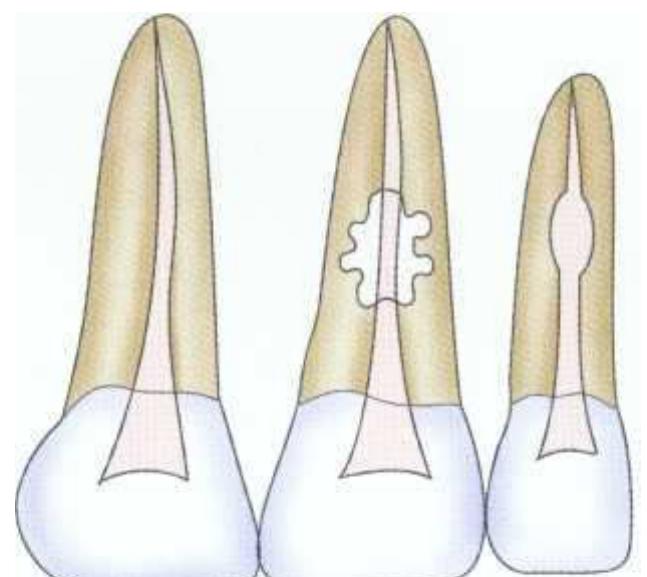-17 radiographs are useful in diagnosis. external re-