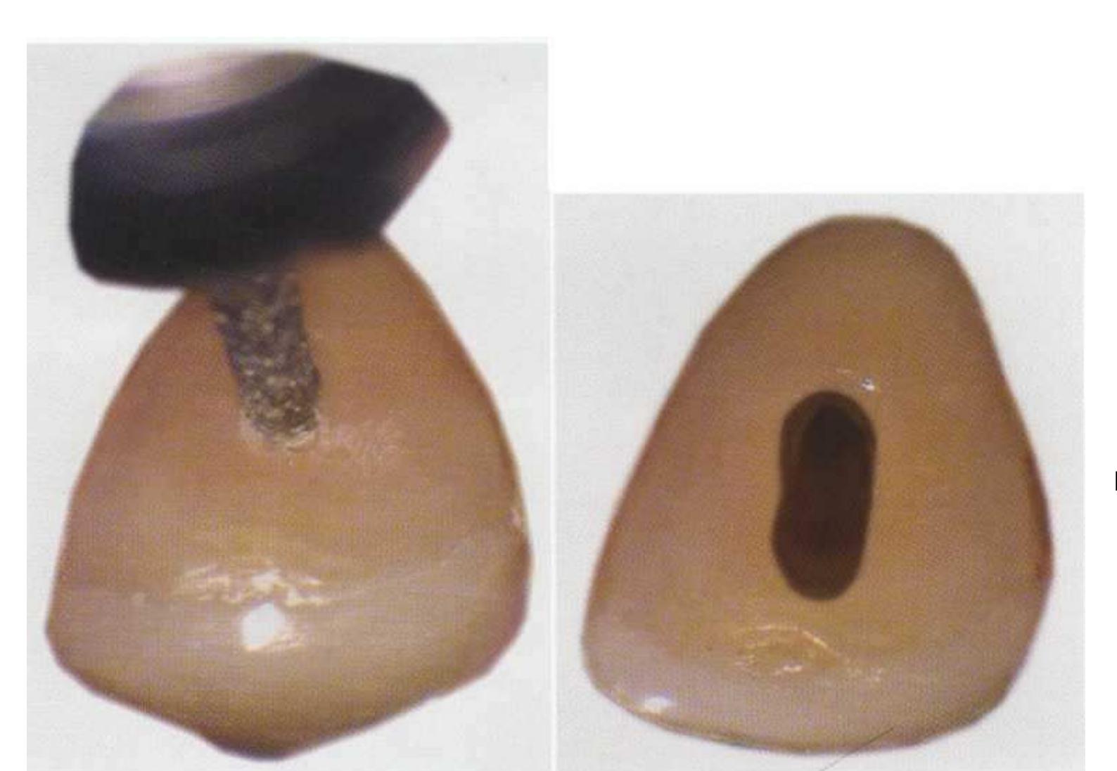 -17 access opening for the maxillary canine. figure 2-18 a,