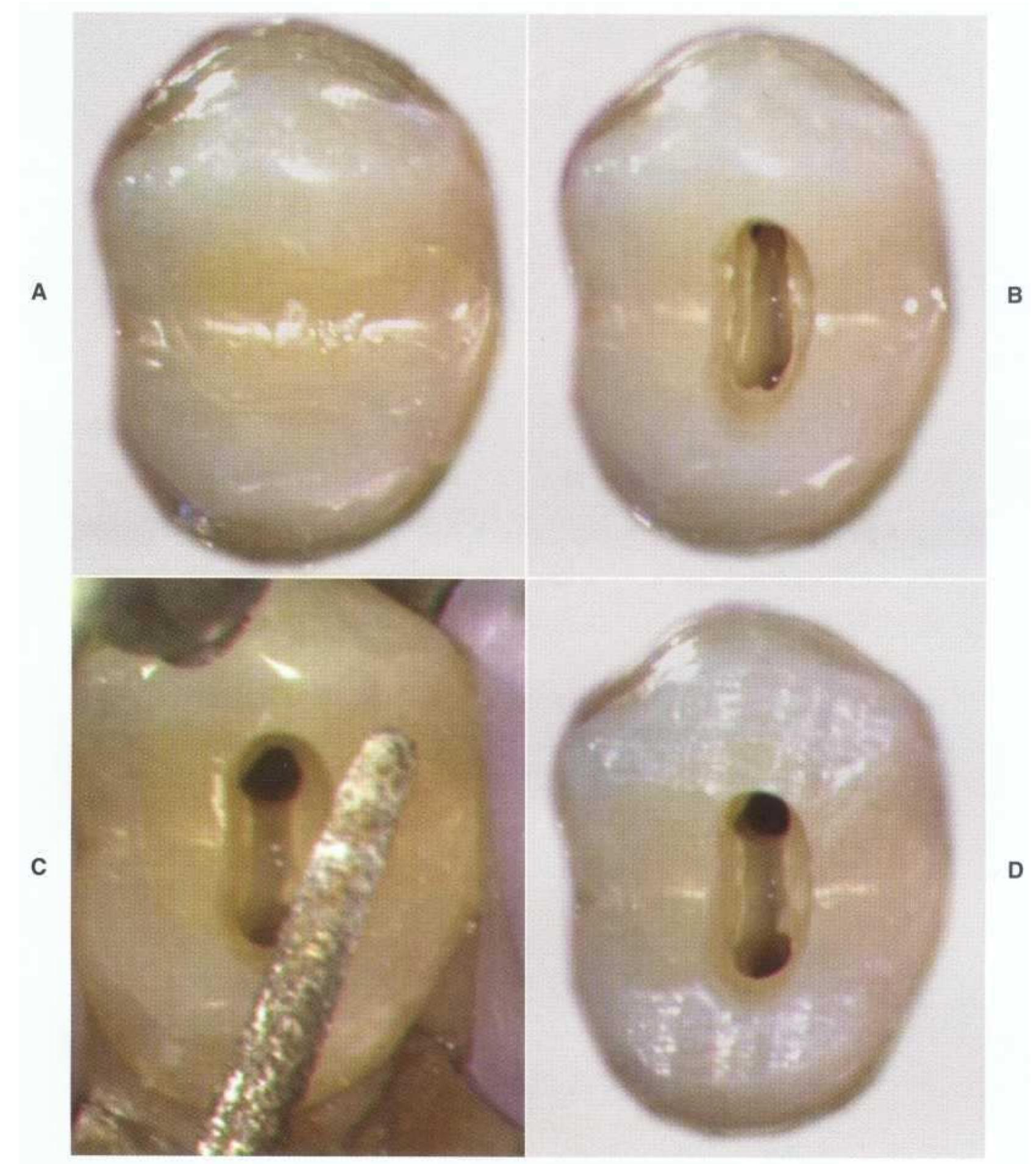 -21 a, preoperative view with a distal occlusal (do)