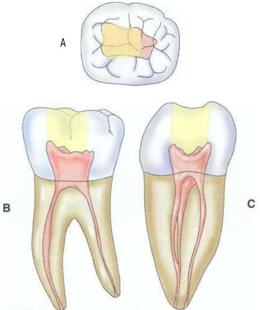 In mandibular molars the mb canal lies under the mesiobuccal