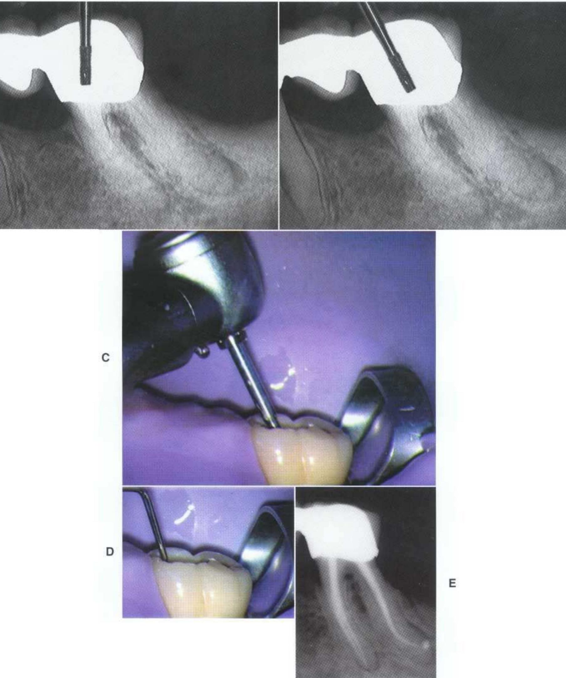 -56 a, penetrating perpendicular to the occlusal surface of