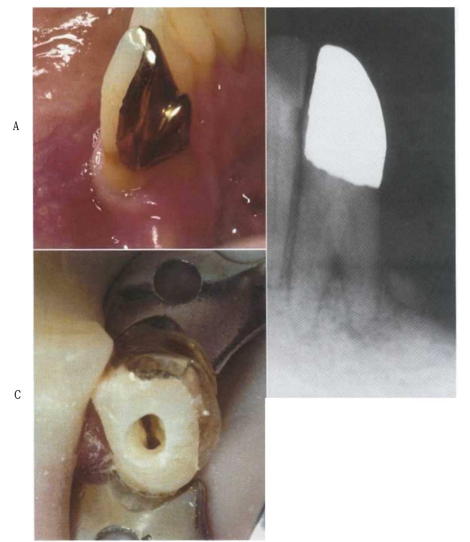 -57 a, this mandibular canine was restored with a