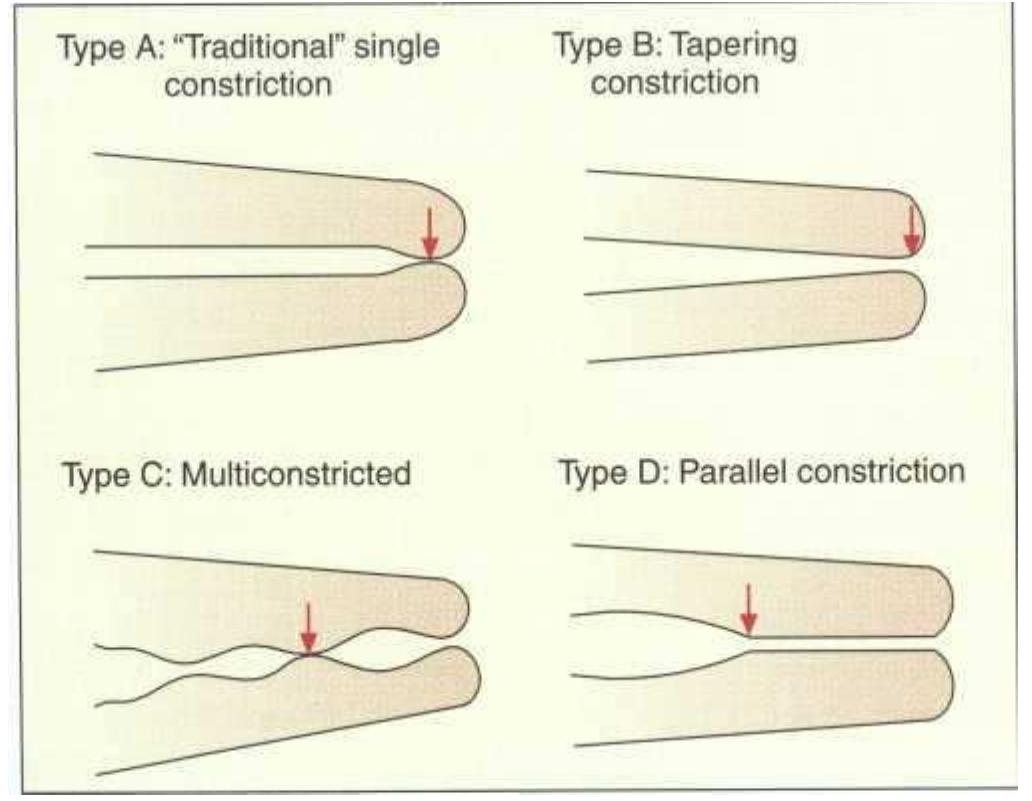 -9 dummer's classifications of apical canal anatomy (redrawn