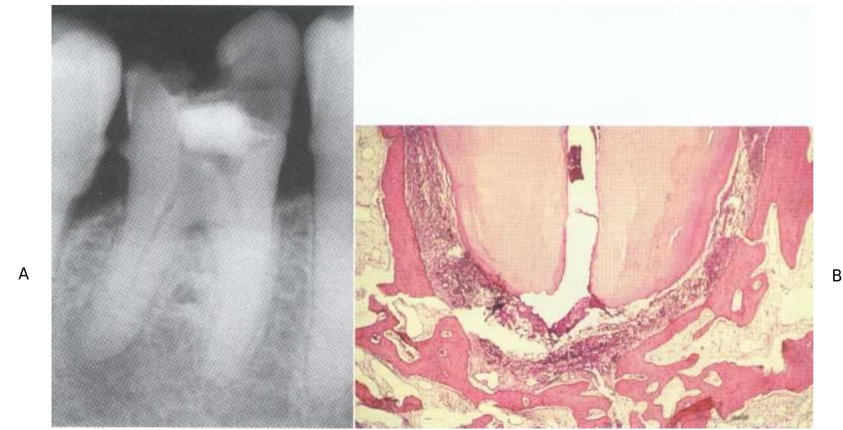 -11 radiograph (a) and histologic section (b) of distal root