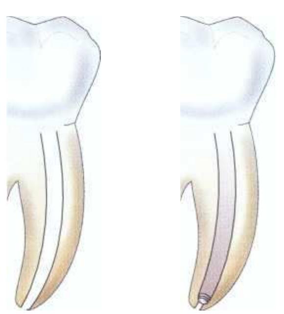 Obturating material, and fill the space completely. the