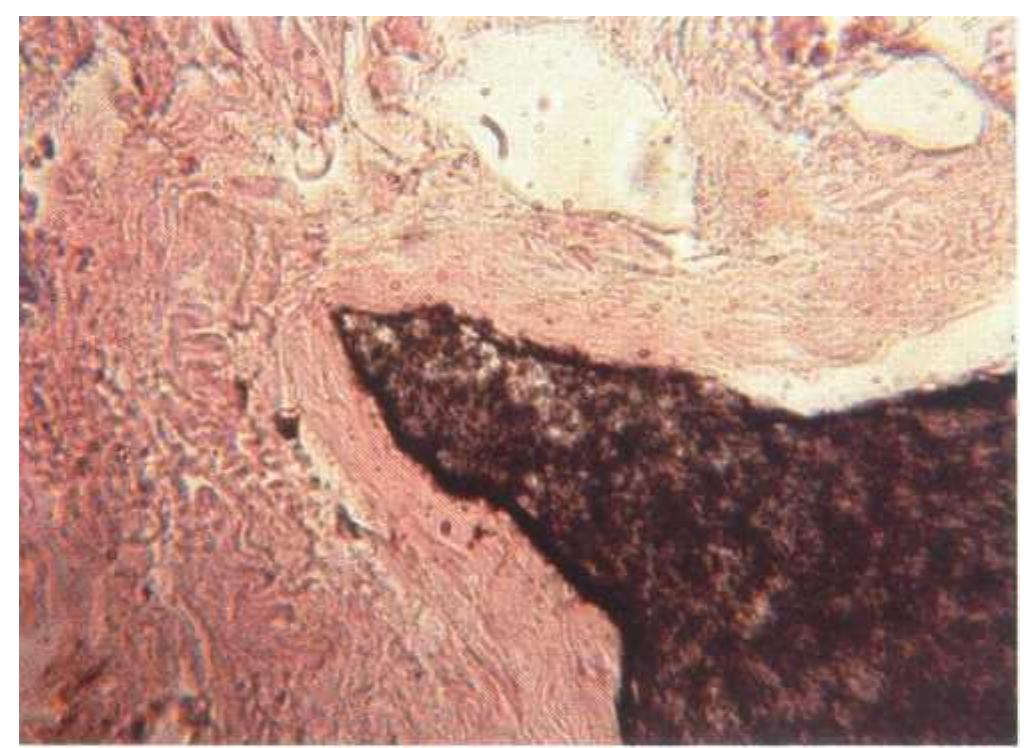 -9 gutta-percha is relatively inert in periradicular con-