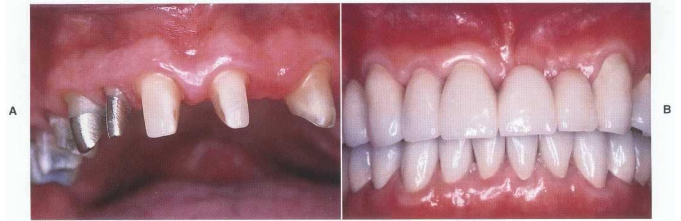 -1 a, teeth #6 and #7 restored with cast post and core