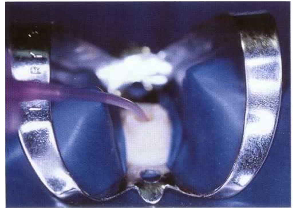 -16 the capillary suction tip in the endoeze system allows