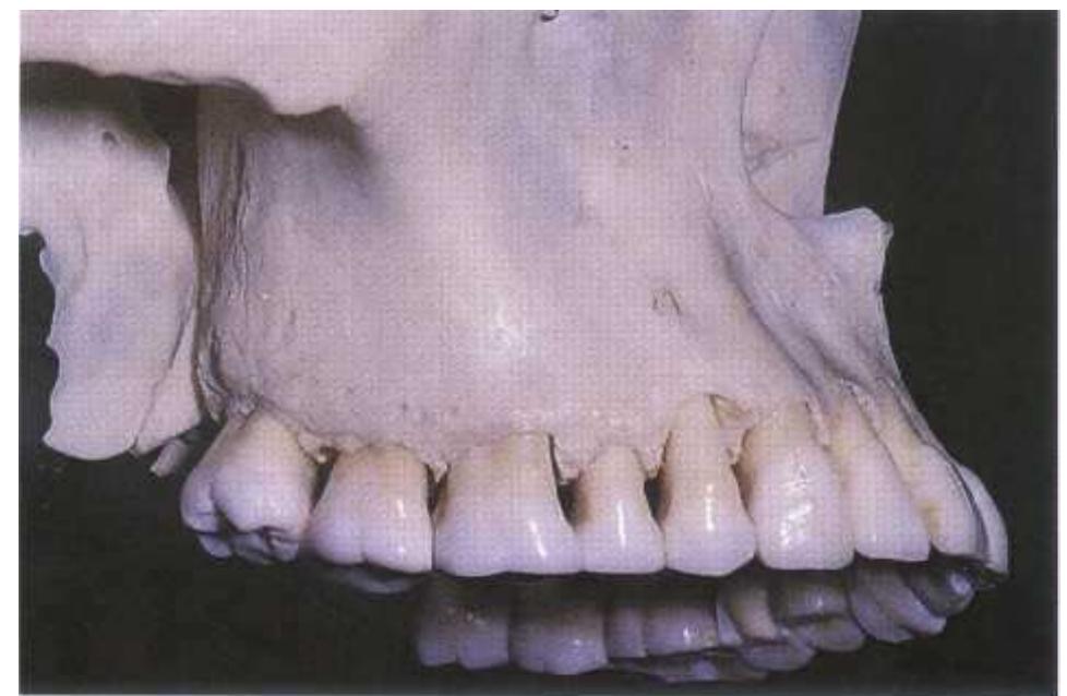 -2 skull specimen demonstrating the maxillary pos- terior