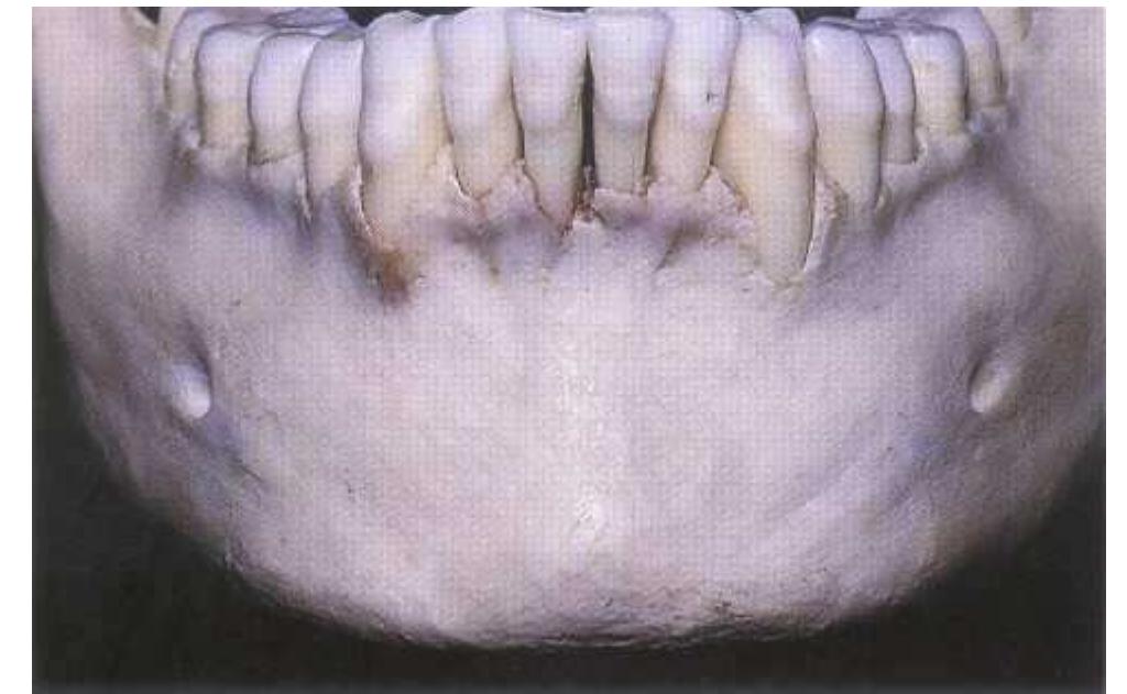 -4 the mandibular anterior region of the mandible. note the