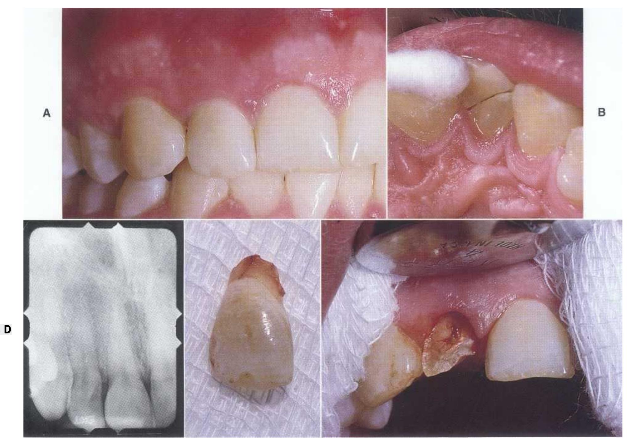 -6 a andb, clinical photographs of a maxillary right lateral