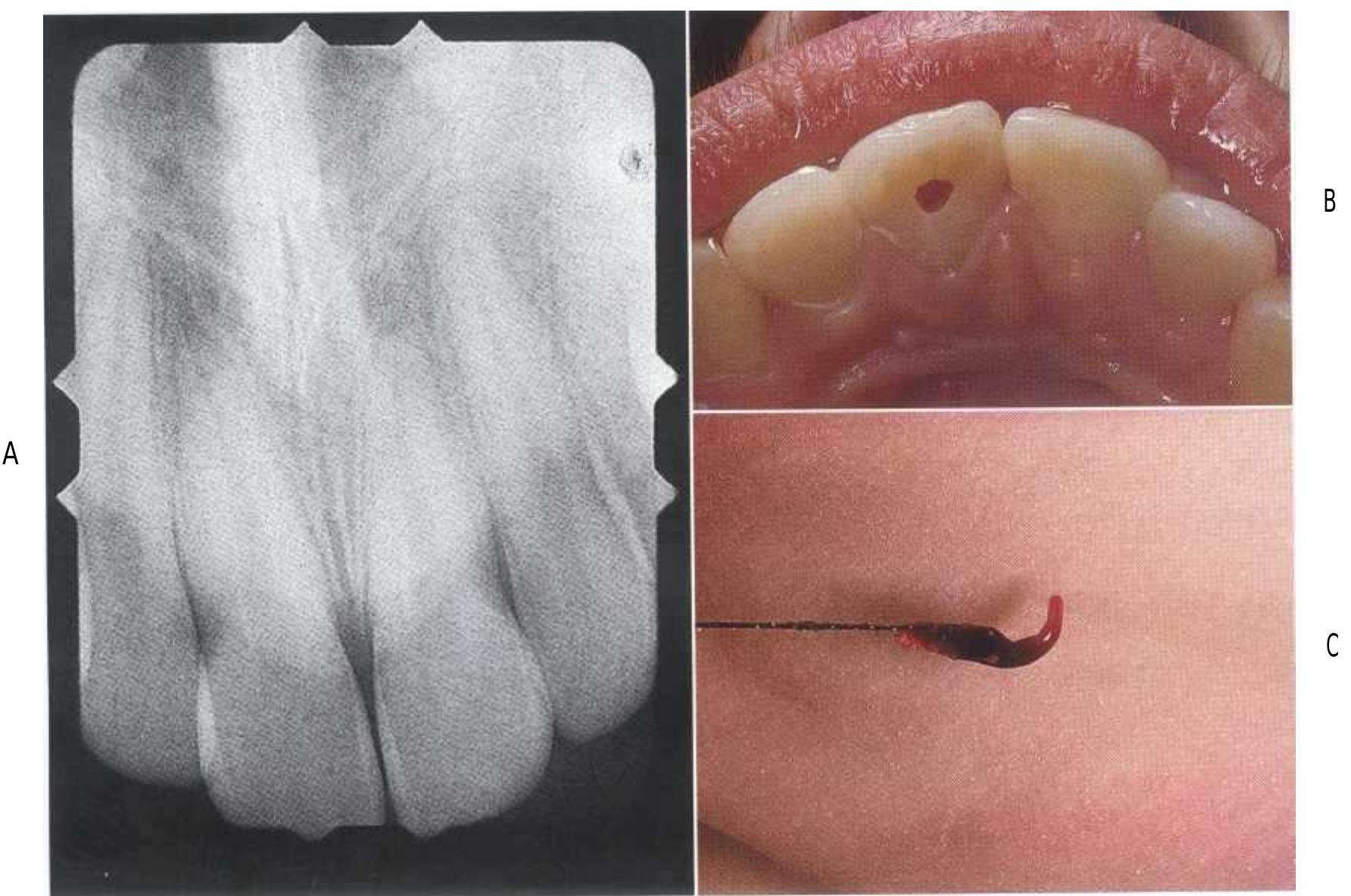 -12 a,a preoperative radiograph of a maxillary right central