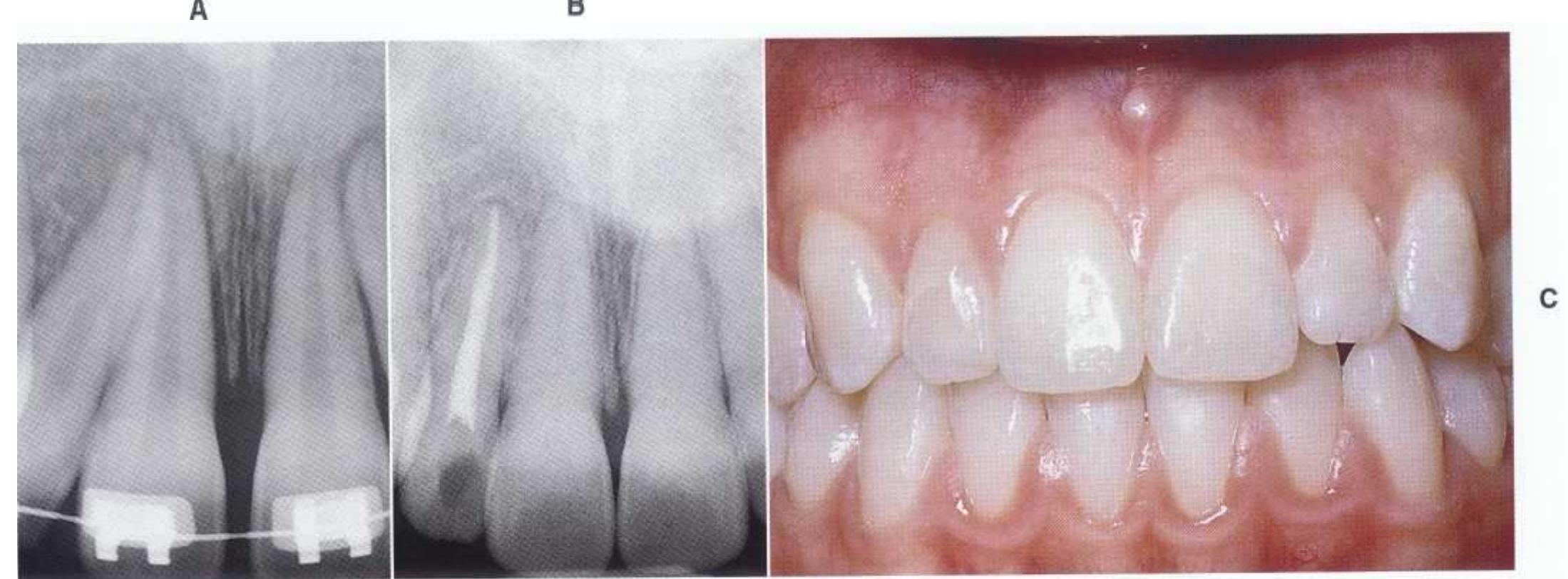 -13. a,a preoperative radiograph of a maxillary right