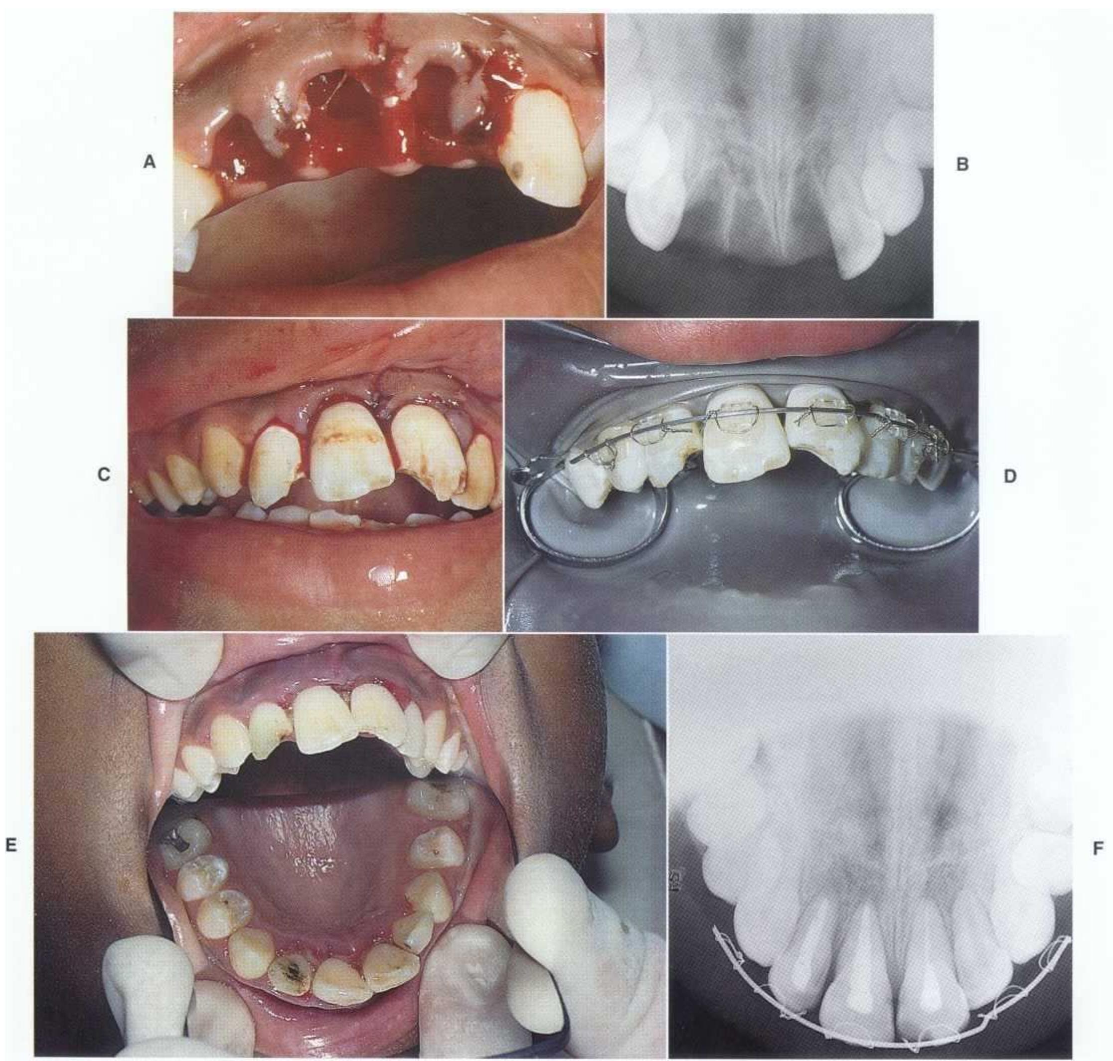 -15 a, a photograph of a patient who avulsed his maxillary