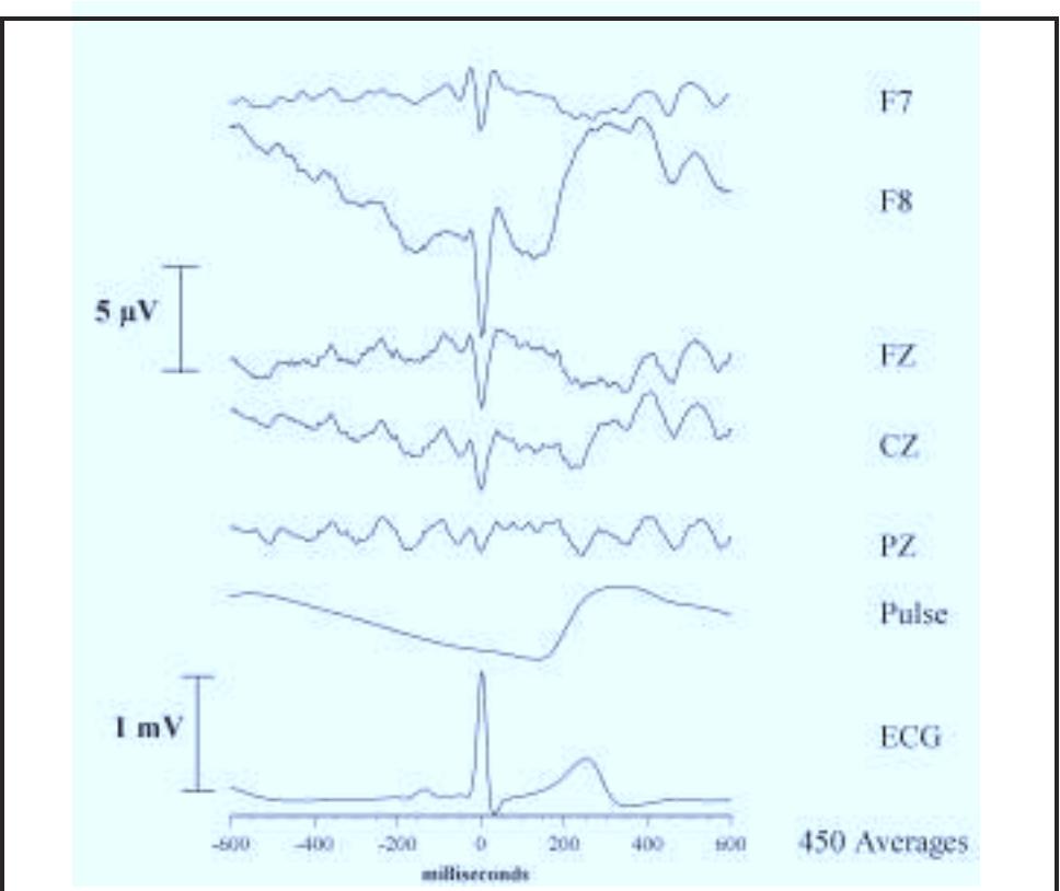 This figure shows an example of typical heartbeat evoked