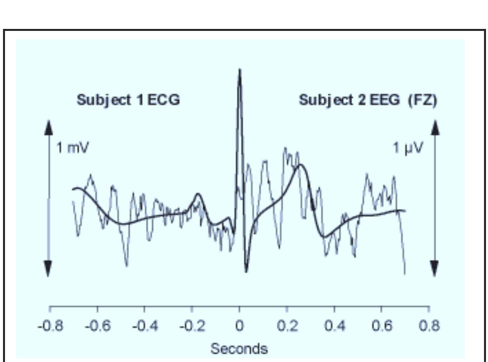 Overlay of signal averaged eeg and ecg. this graph is an