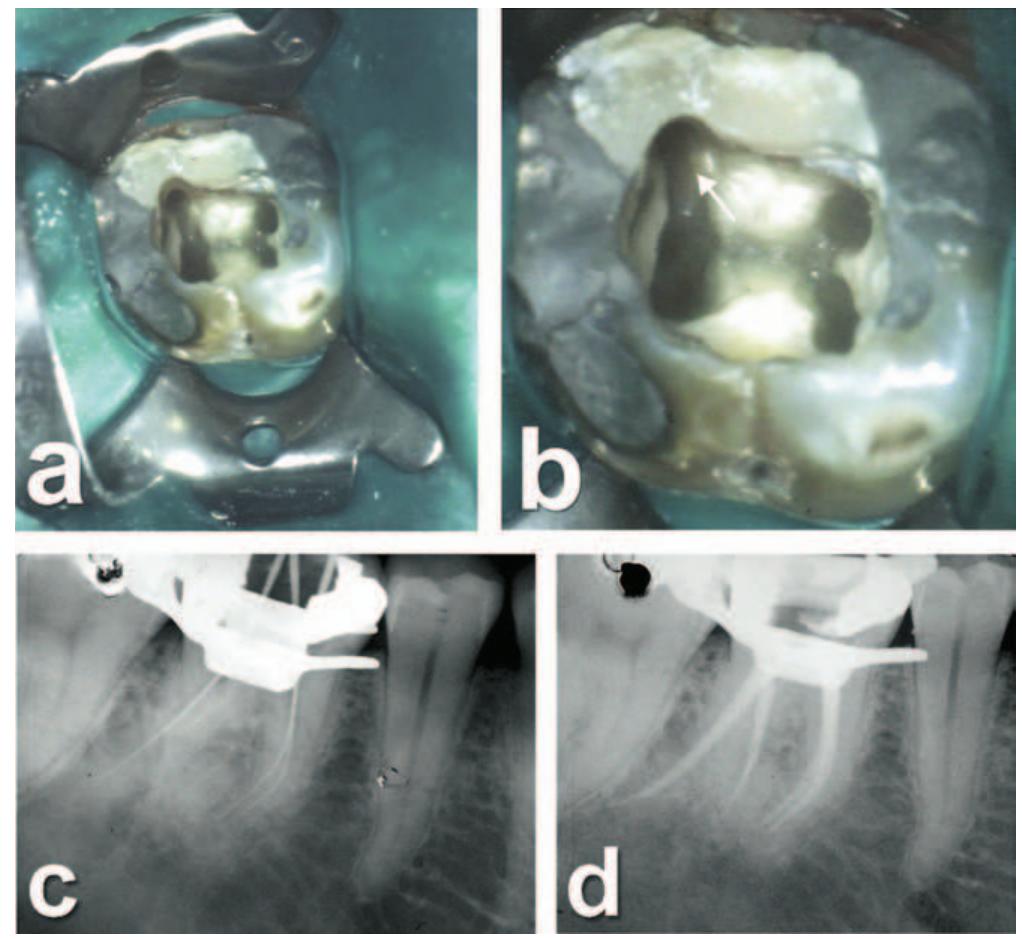 (a, b) occlusal view of the pulp chamber floor with the