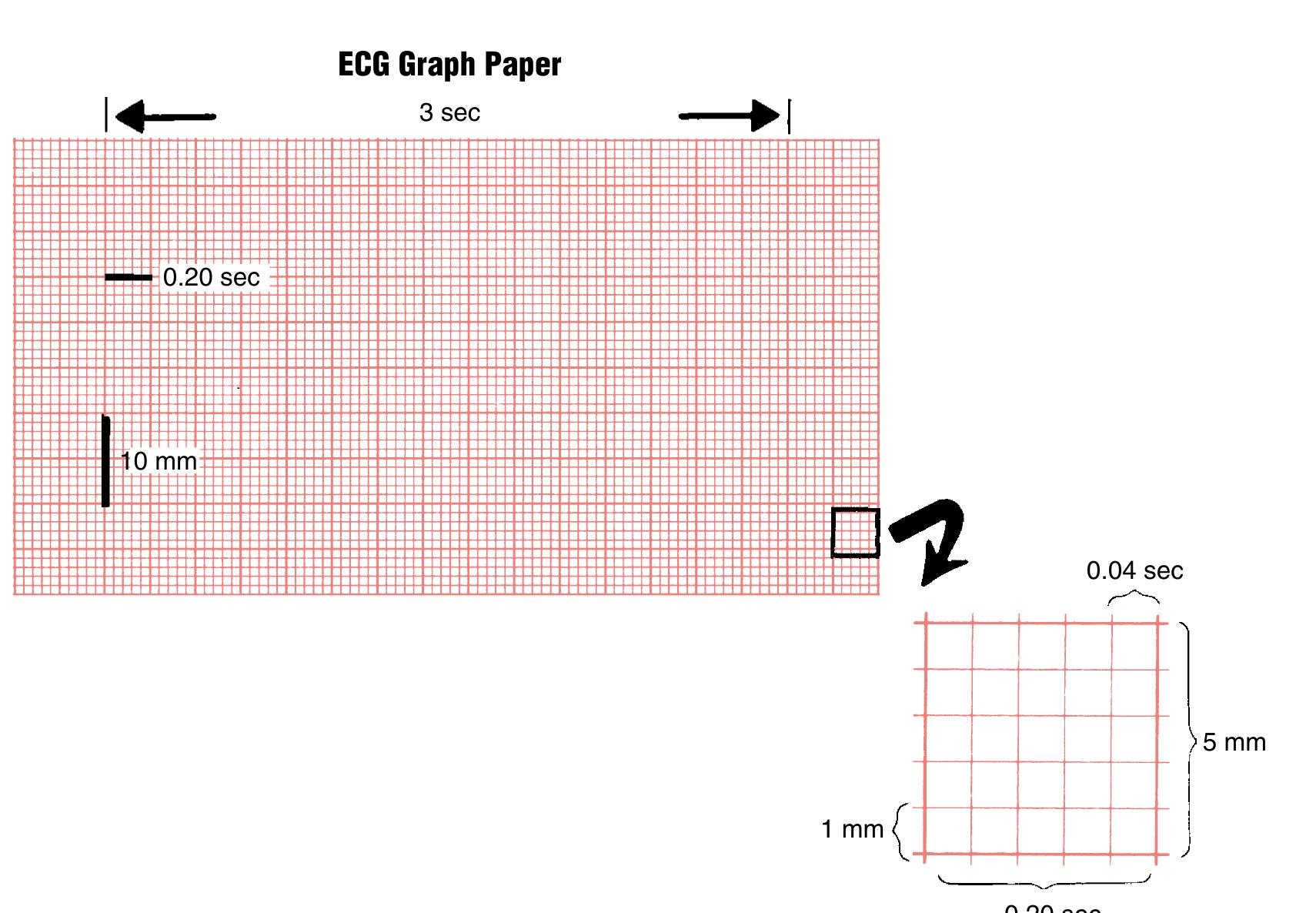 Figure 5 - from Goldbergers clinical electrocardiography a