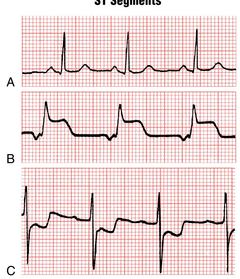 -11. st segments. a, normal. b, abnormal eleva- tion. c,