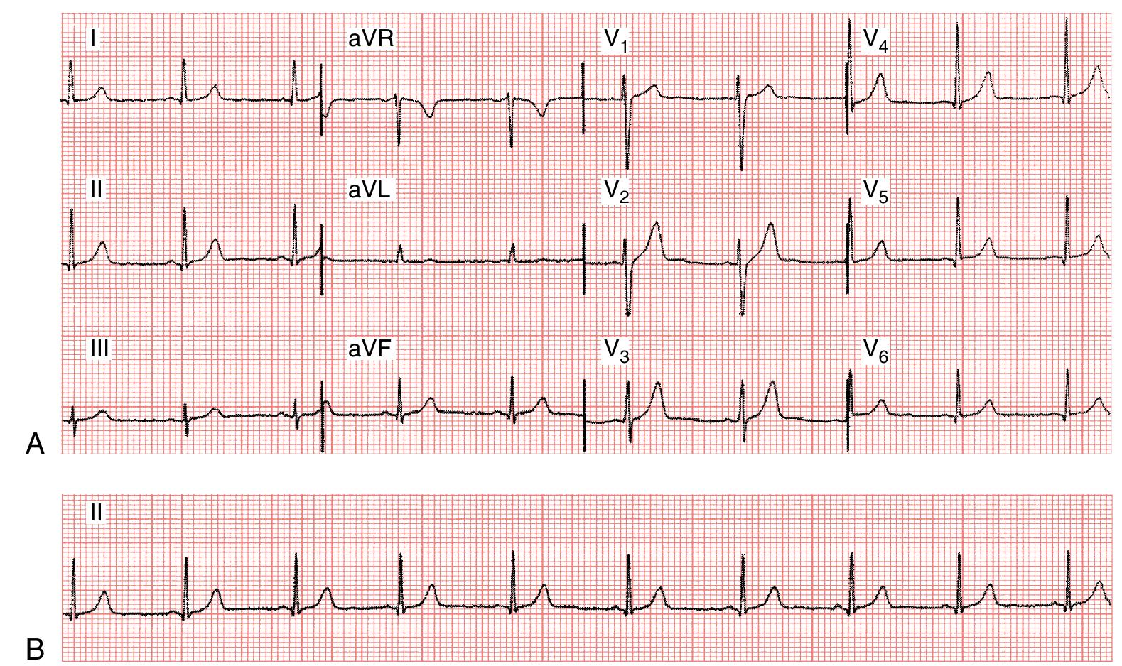 -2. a, sample ecg showing the 12 standard leads. b, a lead