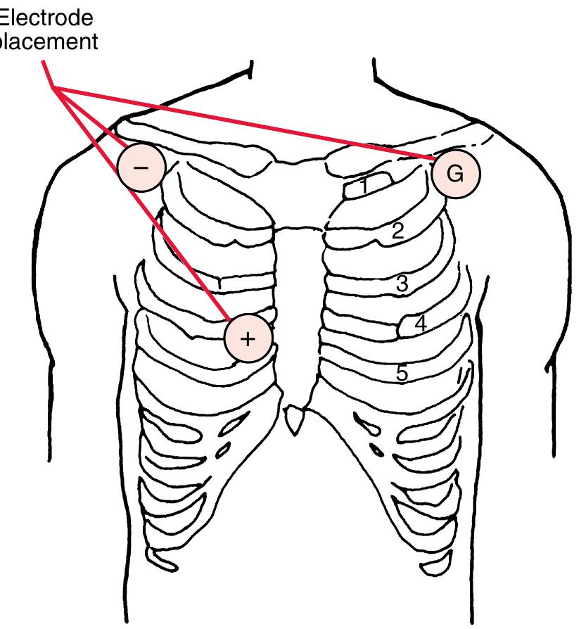 -13. monitor lead. a chest electrode (+) is placed at the