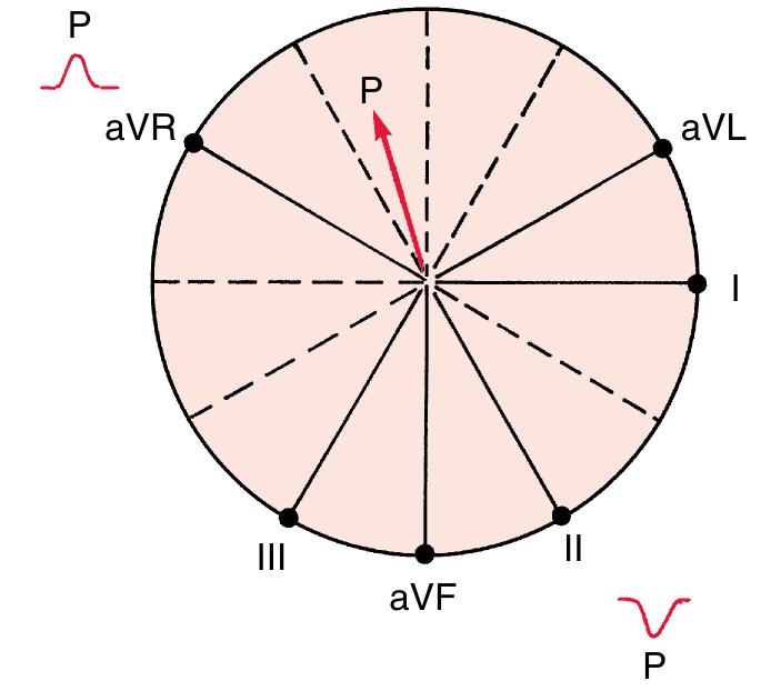 -5. with atrioventricular (av) junctional rhythm (or low