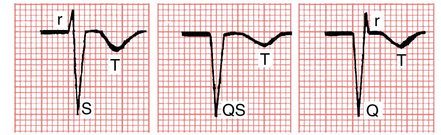 -9. lead avr normally shows one of three basic nega- tive
