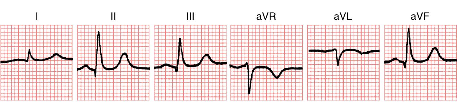 -11. with a vertical qrs position (axis), leads ii, iii, and