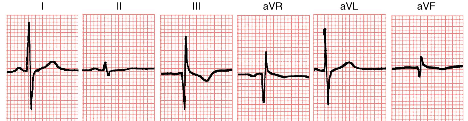 -14. indeterminate axis. notice the biphasic complexes (rs
