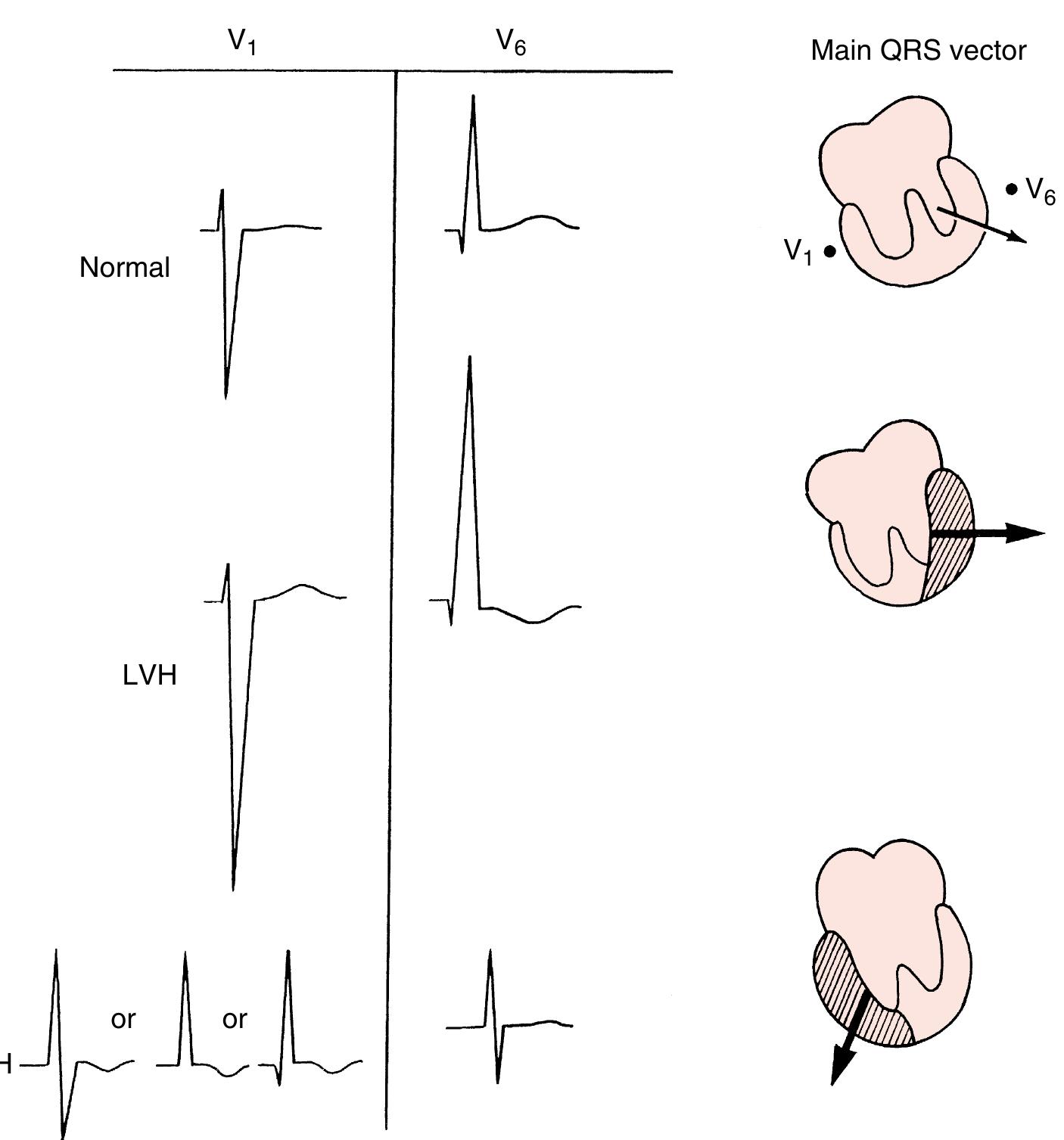 (PDF) Goldbergers clinical electrocardiography a simplified approach