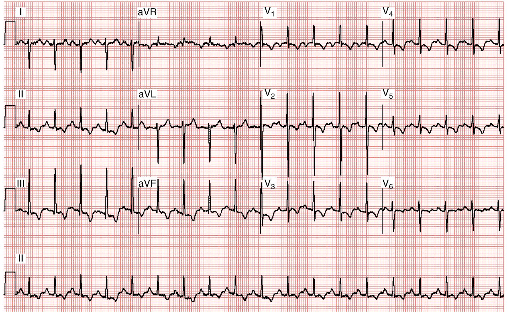 (PDF) Goldbergers clinical electrocardiography a simplified approach
