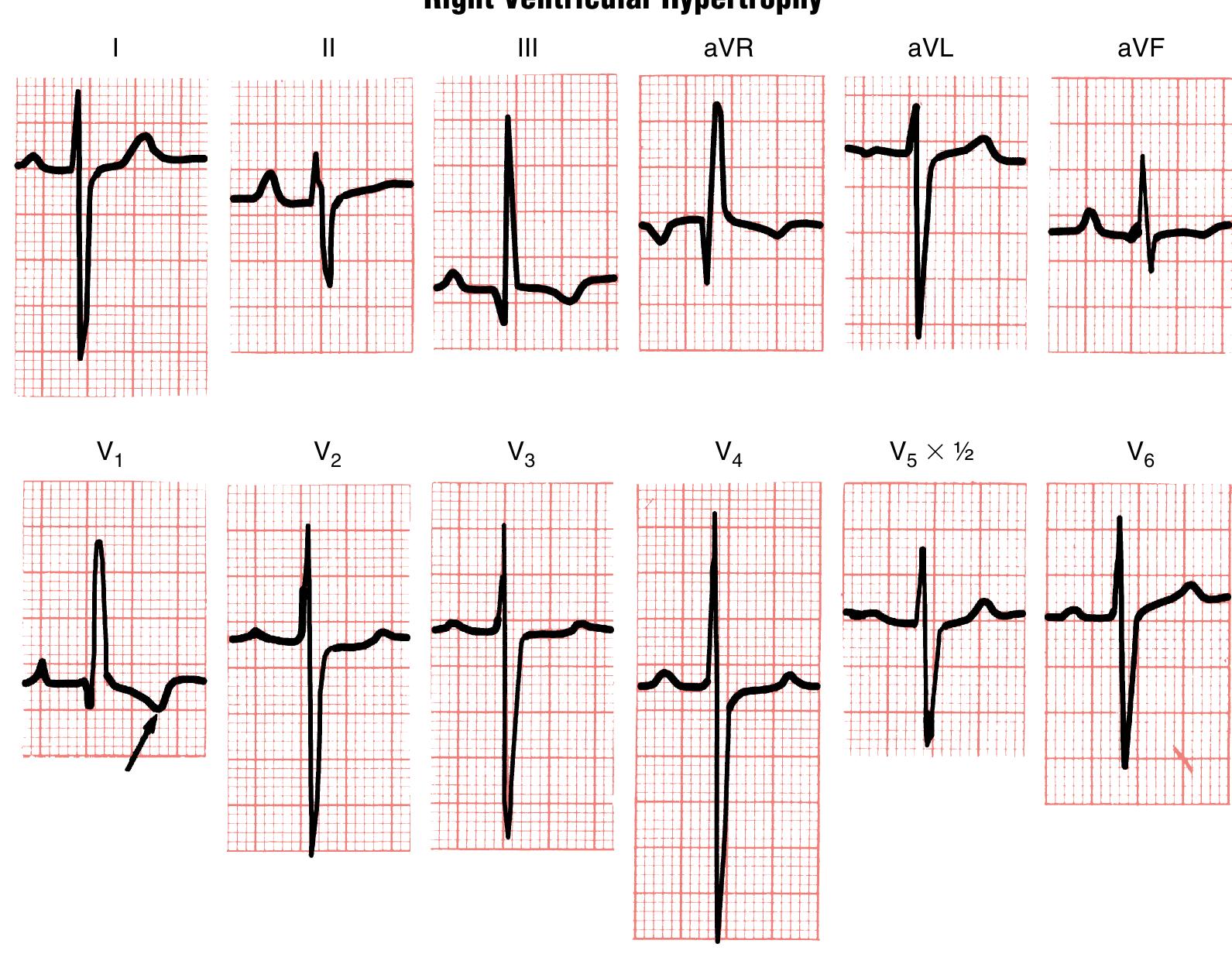 -9. with right ventricular hypertrophy, lead v; sometimes
