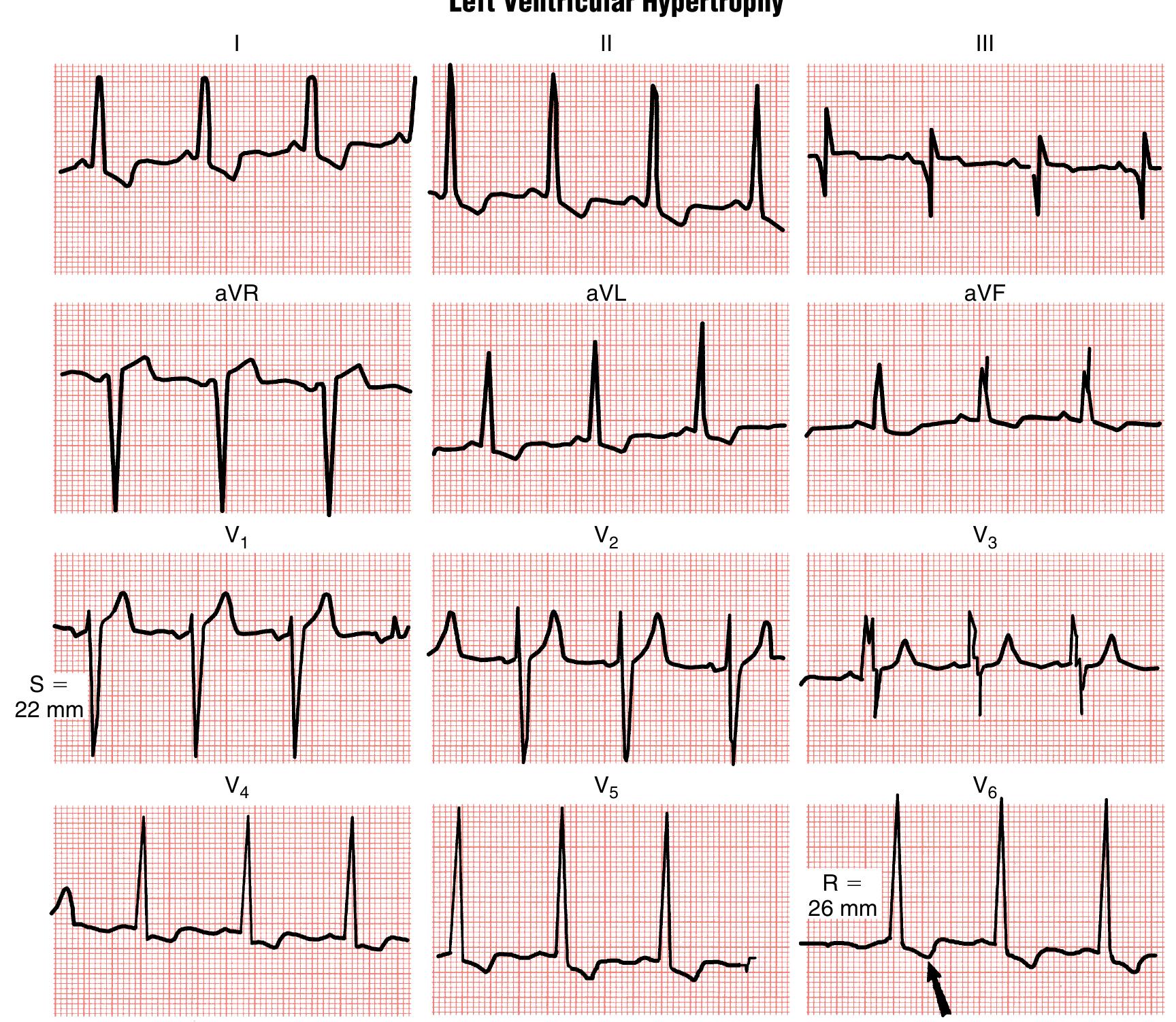 -10. pattern of left ventricular hypertrophy in a patient