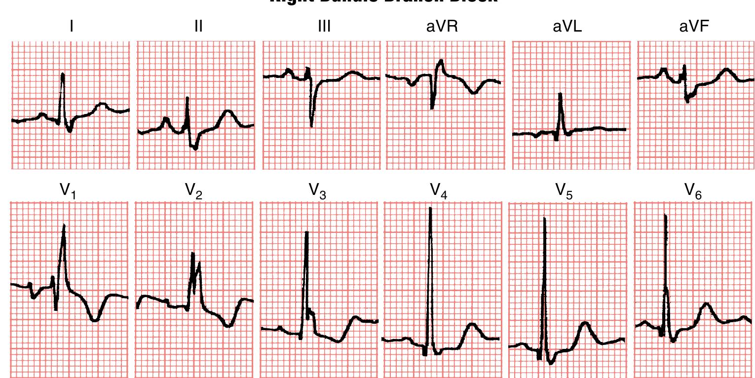 -2. notice the wide rsr’ complex in lead v, and the qrs