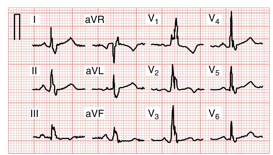 -3. instead of the classic rsr’ pattern with right bun- dle