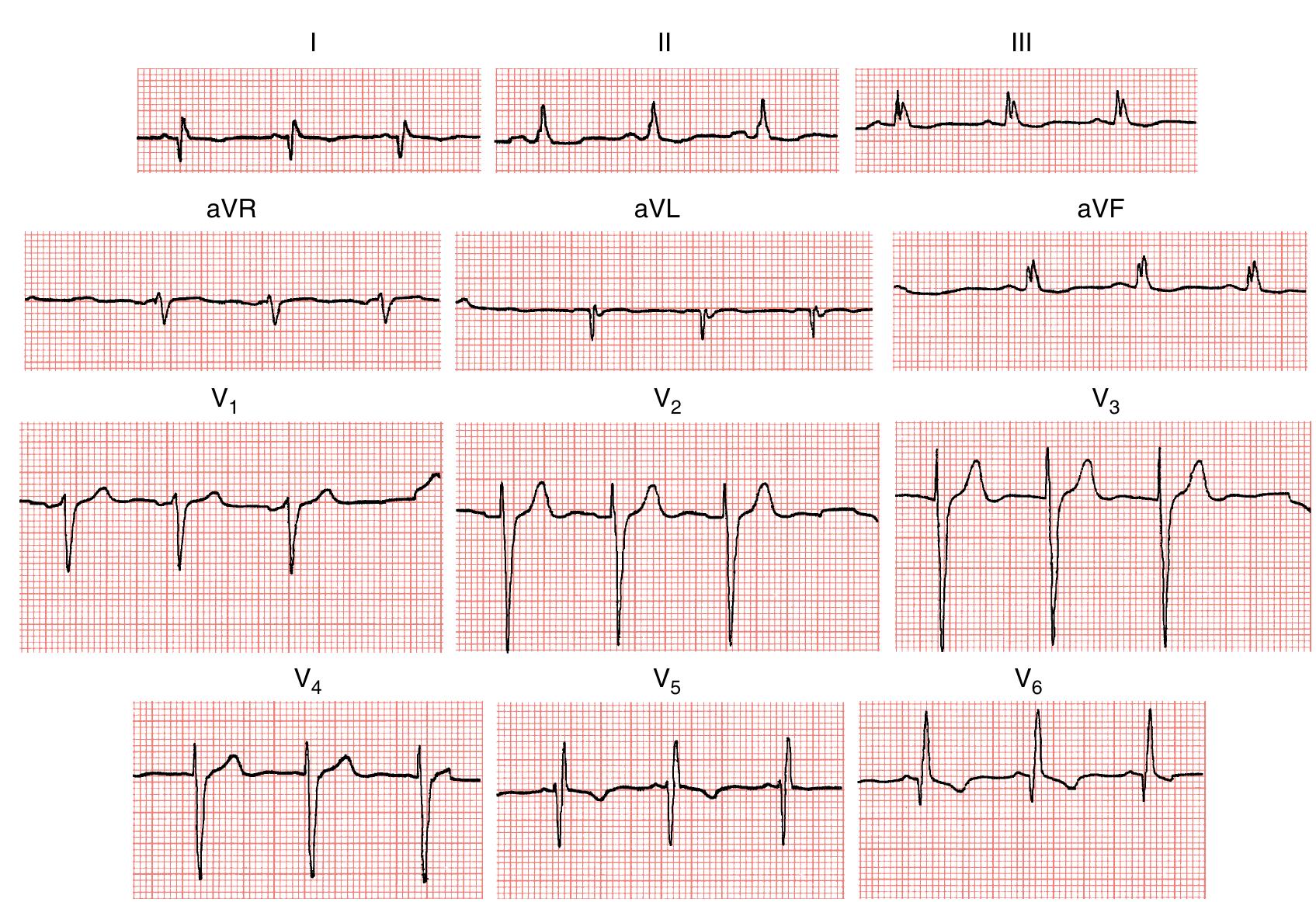 -7. with a nonspecific intraventricular conduction delay
