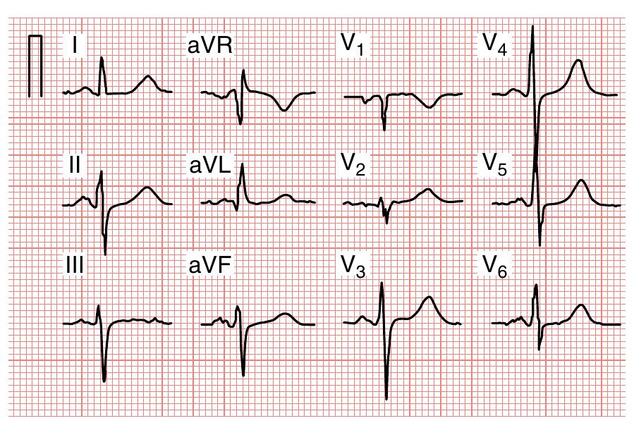 -9. left anterior (hemiblock) fascicular block. notice the