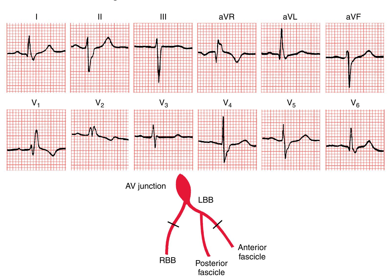 (PDF) Goldbergers clinical electrocardiography a simplified approach