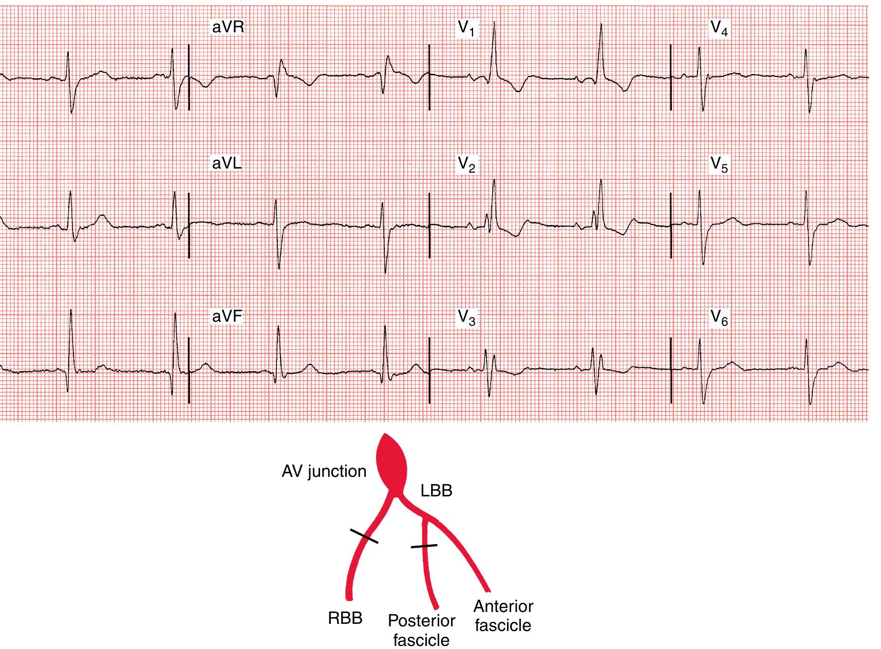 -11. bifascicular block (right bundle branch block [rbbb]