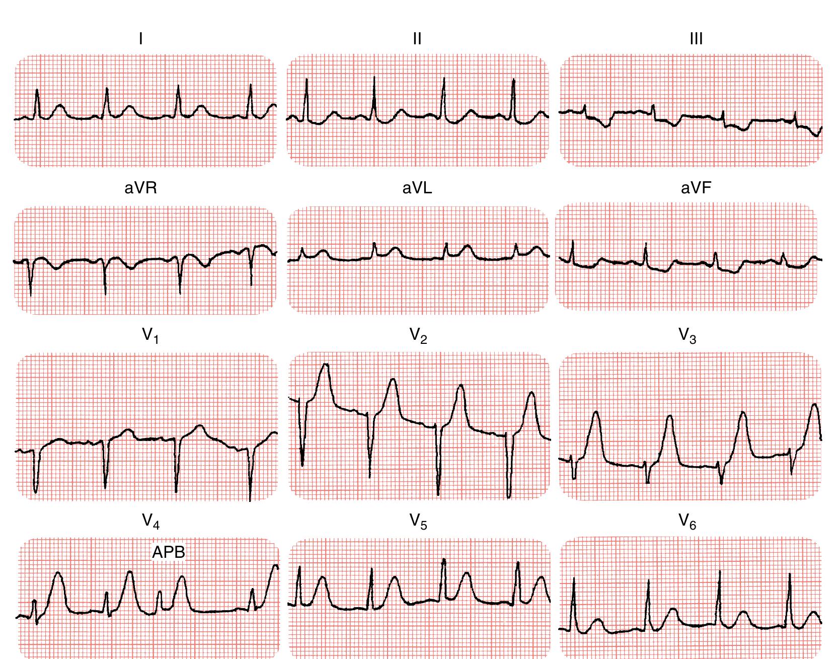 -8. hyperacute t waves with anterior st segment elevation