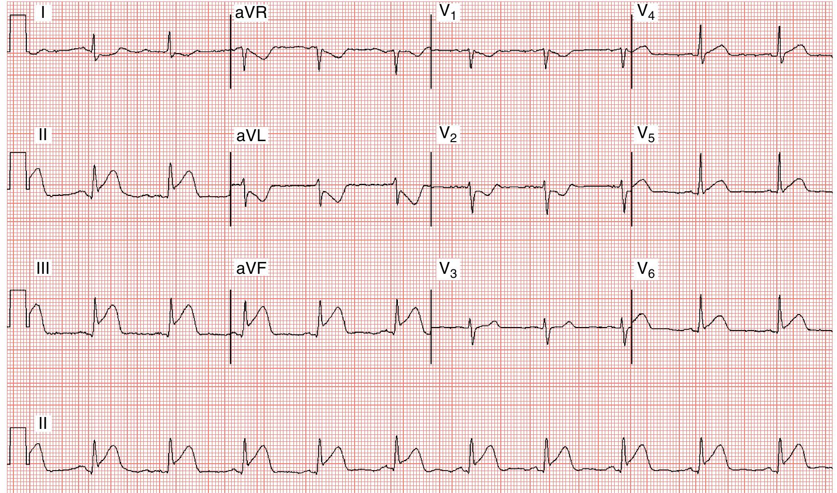 -12. acute inferolateral wall st segment elevation