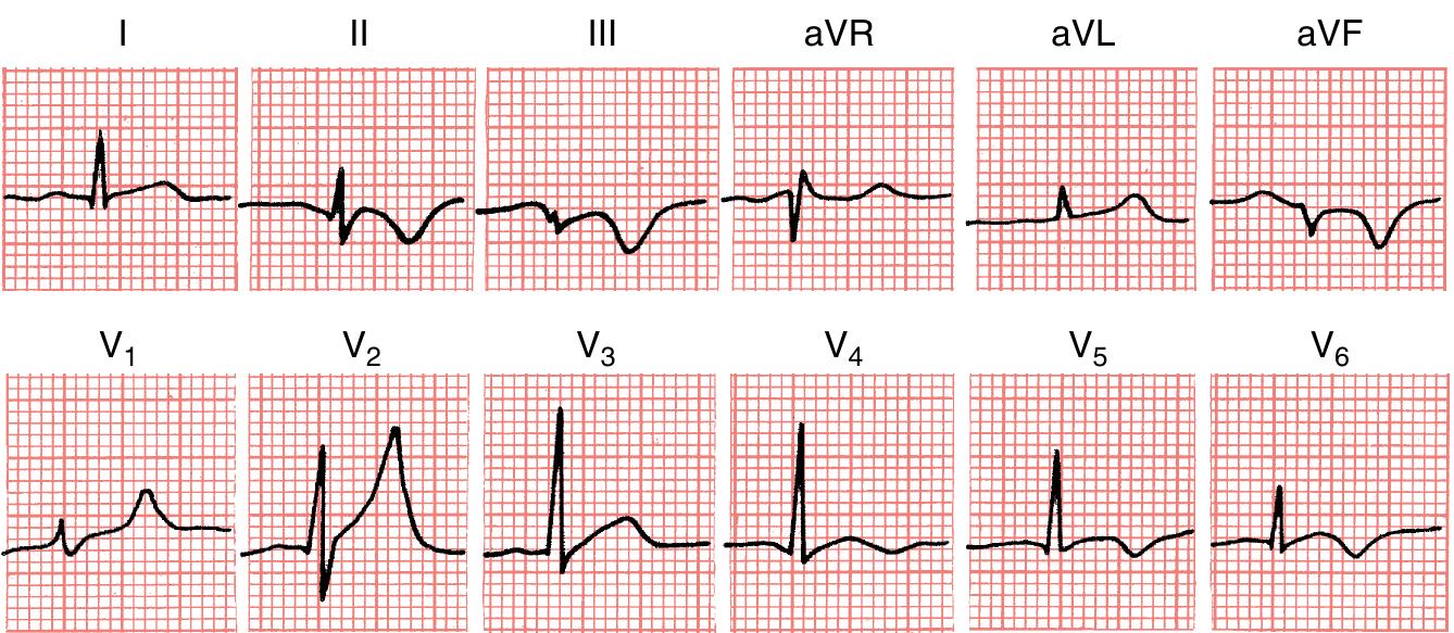 -15. “posterior” infarction. notice the tall r waves in