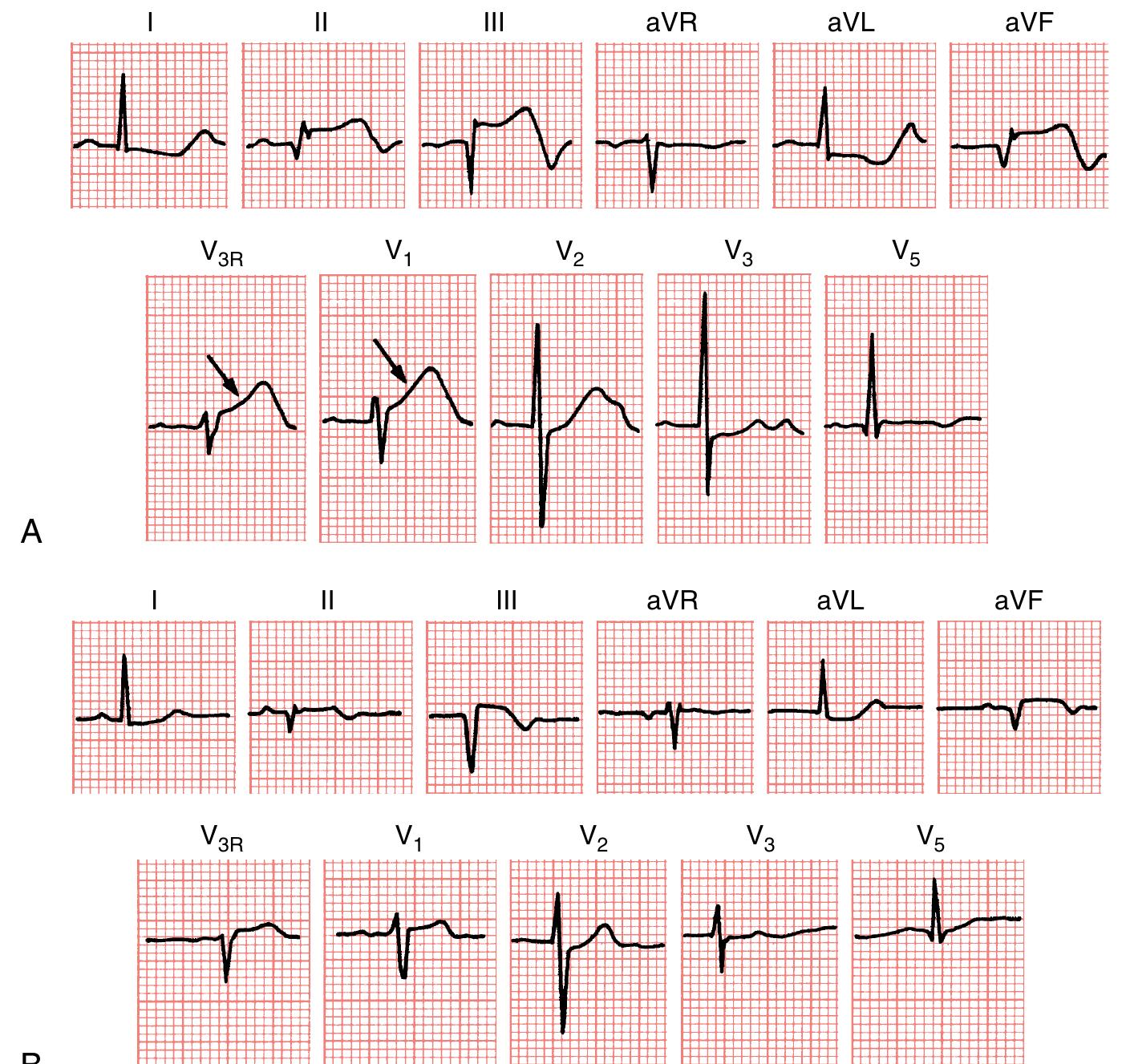 -16. acute right ventricular ischemia with inferior wall