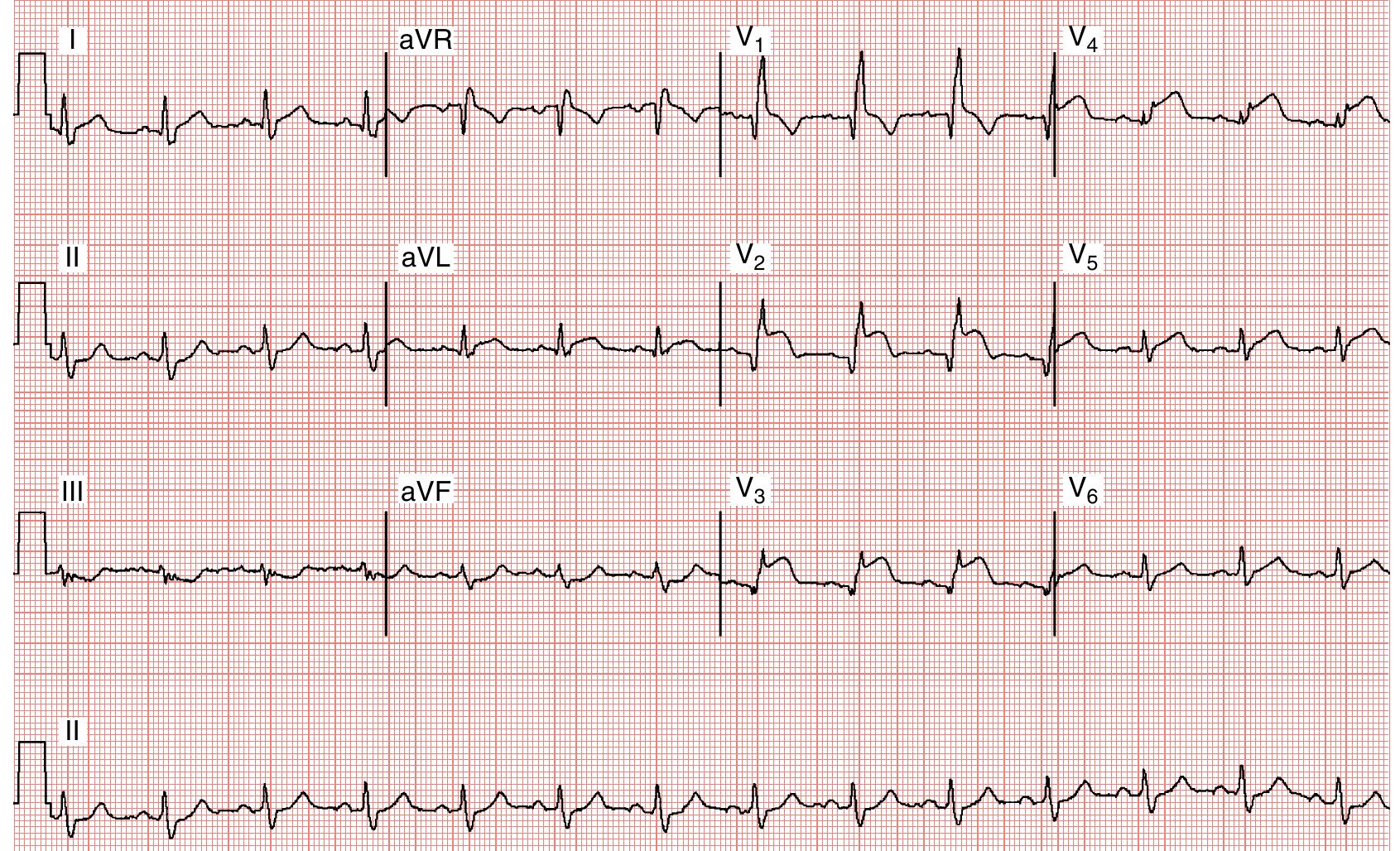-20. acute anterior wall st segment elevation myocardial