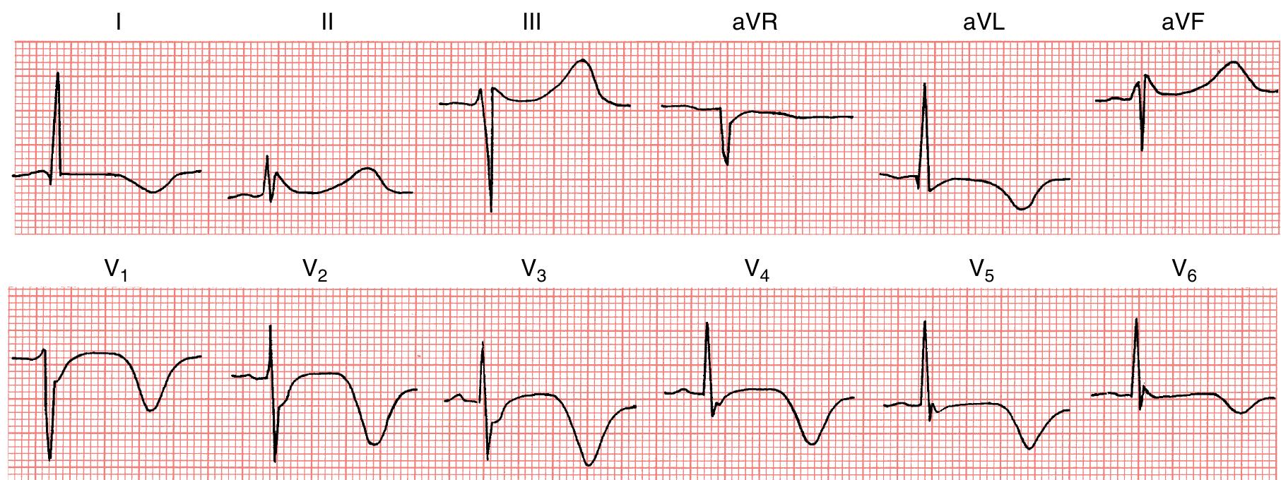 -12. the ecg of a patient with acute subarachnoid hemorrhage
